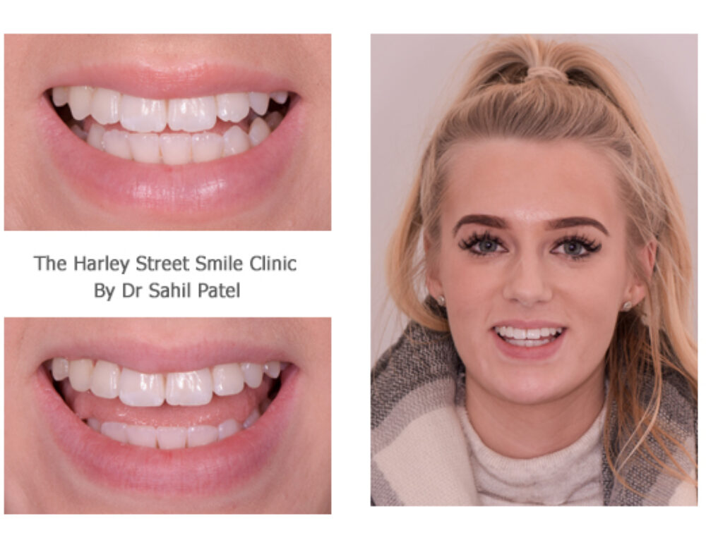 Tooth Contouring 02 - Harley Street Smile