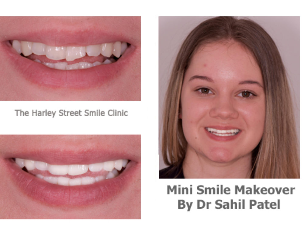 Mini Smile Makeover - Harley Street Smile