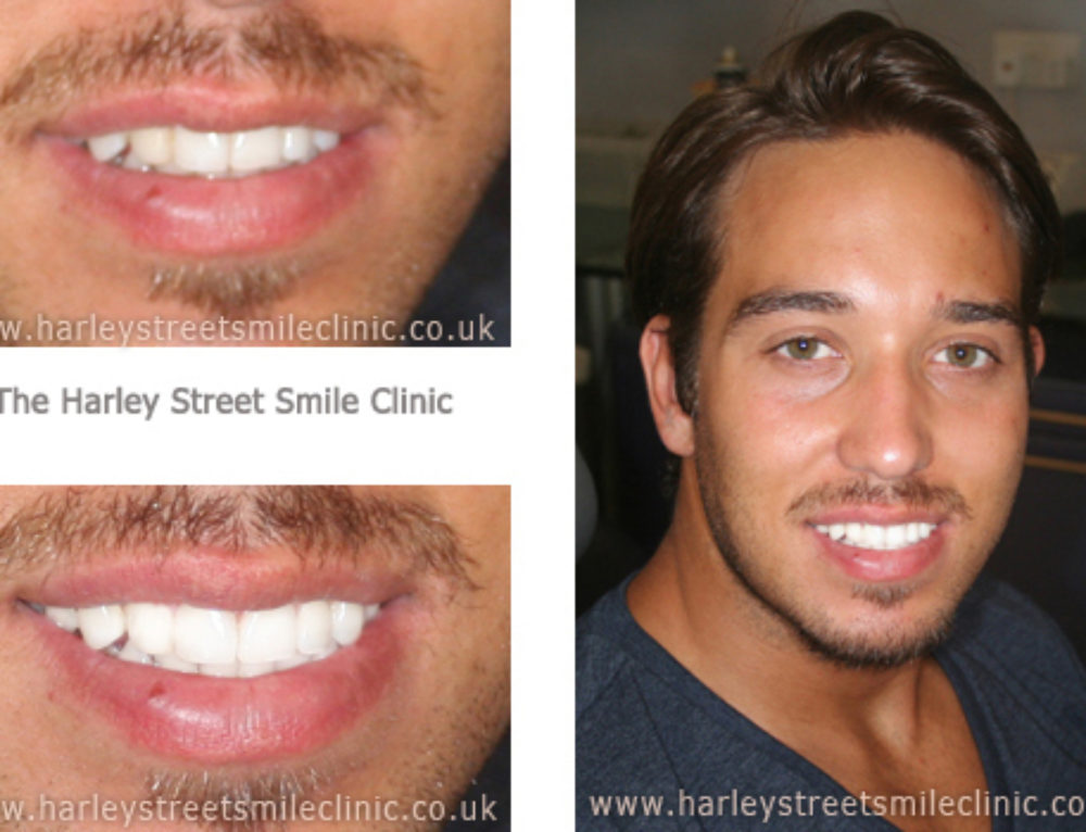 Bobby - TOWIE - Harley Street Smile