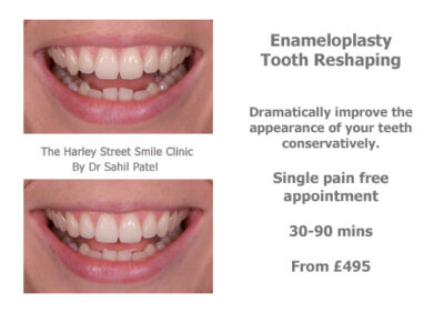 Teeth Contouring and Teeth Reshaping - Harley St Smile