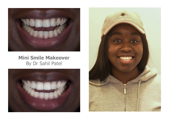 MINI SMILE MAKEOVER GALLERY - Harley Street Smile