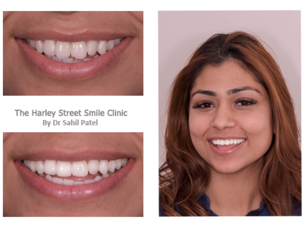 Mini Smile Makeover 04 - Harley Street Smile